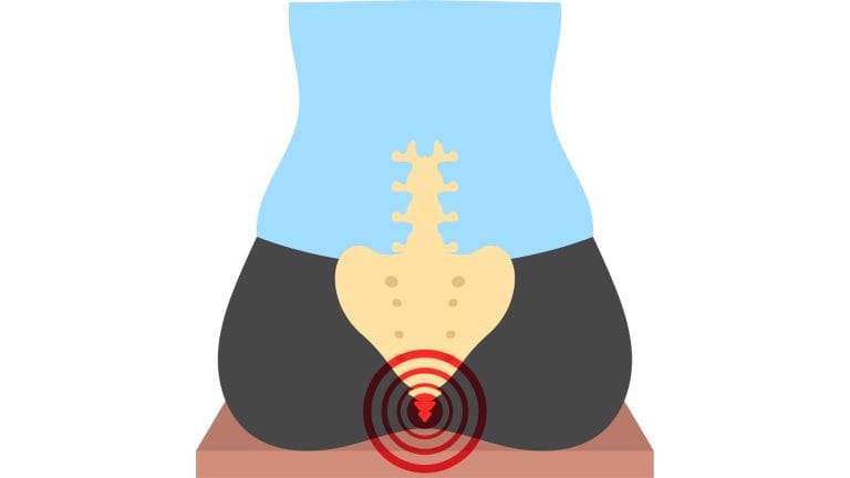 How to Treat Pilonidal Sinus Without Surgery? - ANF