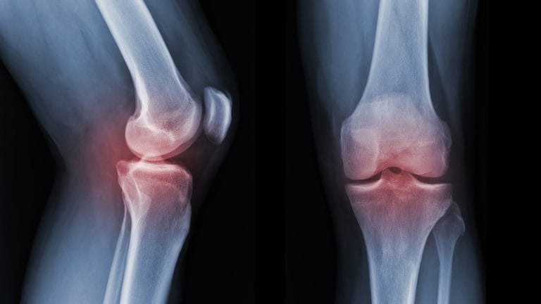 What Happens When You Sprain Your Knee? (And How to Fix It Naturally) - ANF